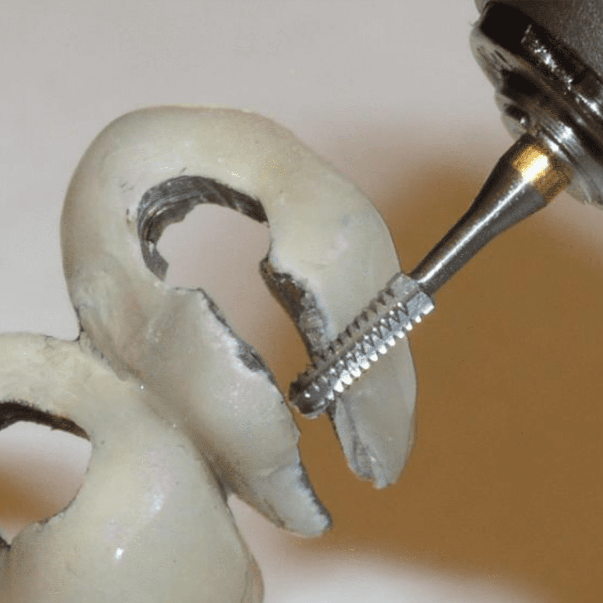 Key to Endo Access - Mandibular and Maxillary Molar Endodontics